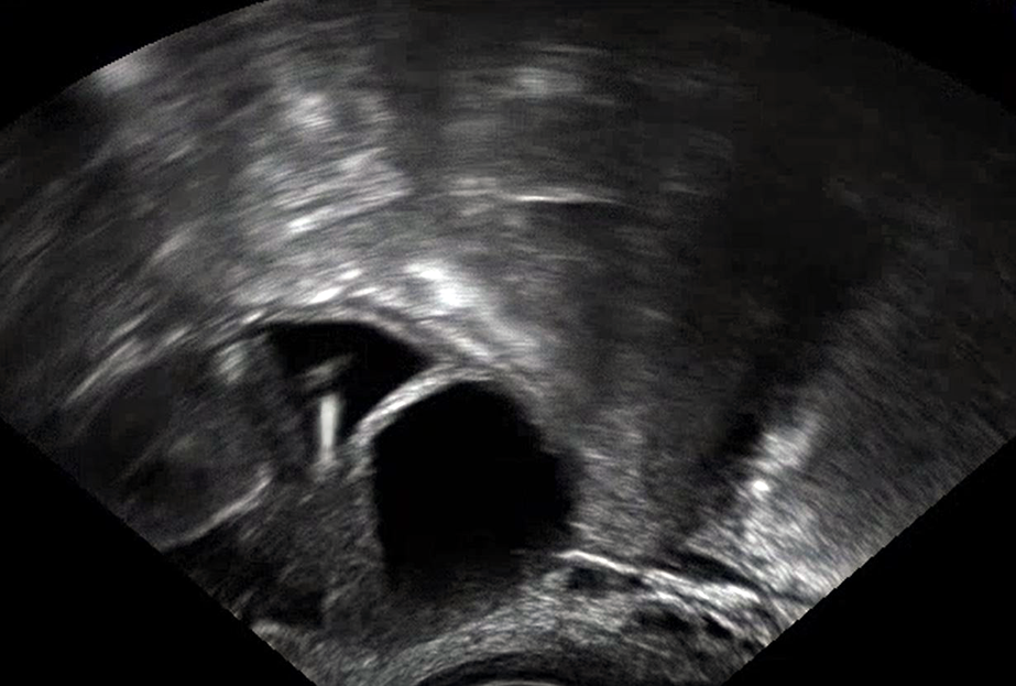 Oocyte retrieval - Vitrolife